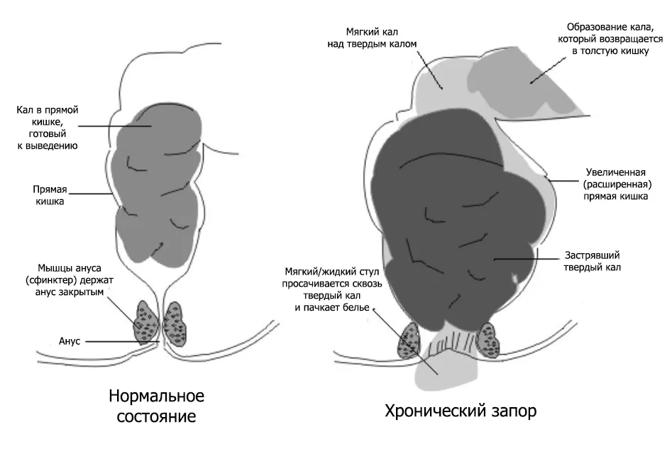 Энкопрез - Центр детского сна и развития BabySleep